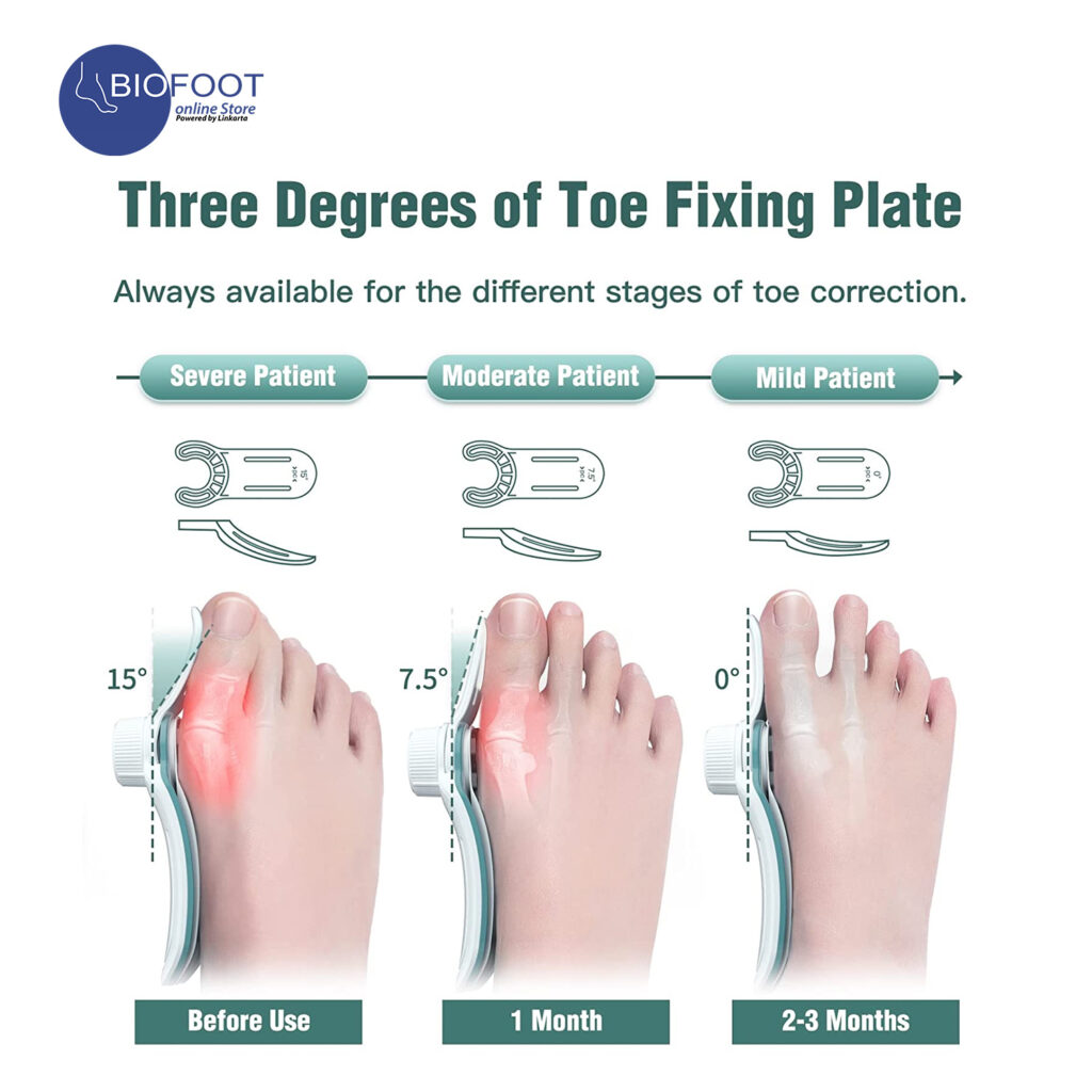 Buy TechLove Tenicore Bunion Corrector XH-WM Per Pc Online Dubai UAE ...