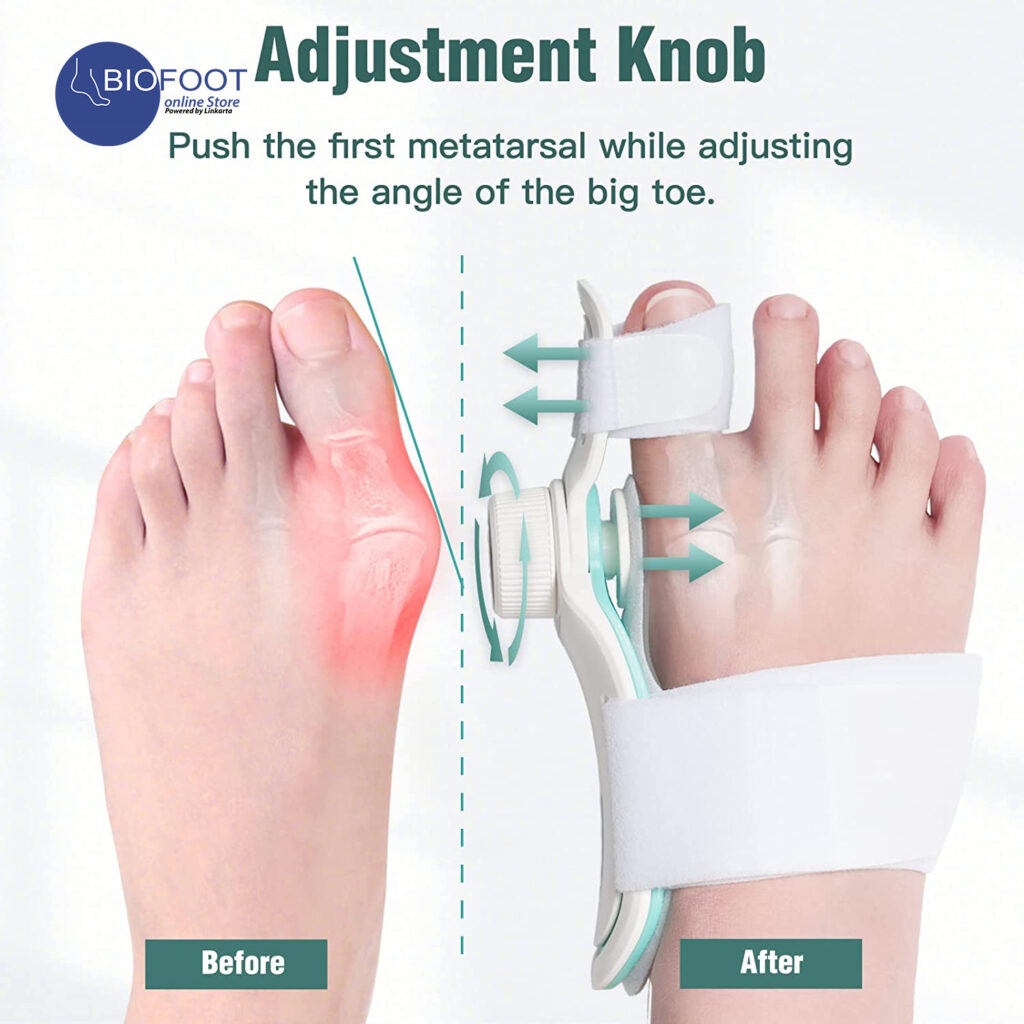 Buy TechLove Tenicore Bunion Corrector XH-WM Per Pc Online Dubai UAE ...