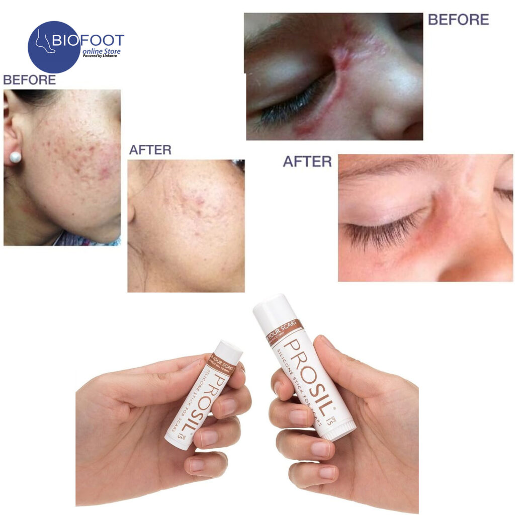 Buy Prosil Silicone Stick for Scars for Kids 4.25g Online Dubai UAE ...